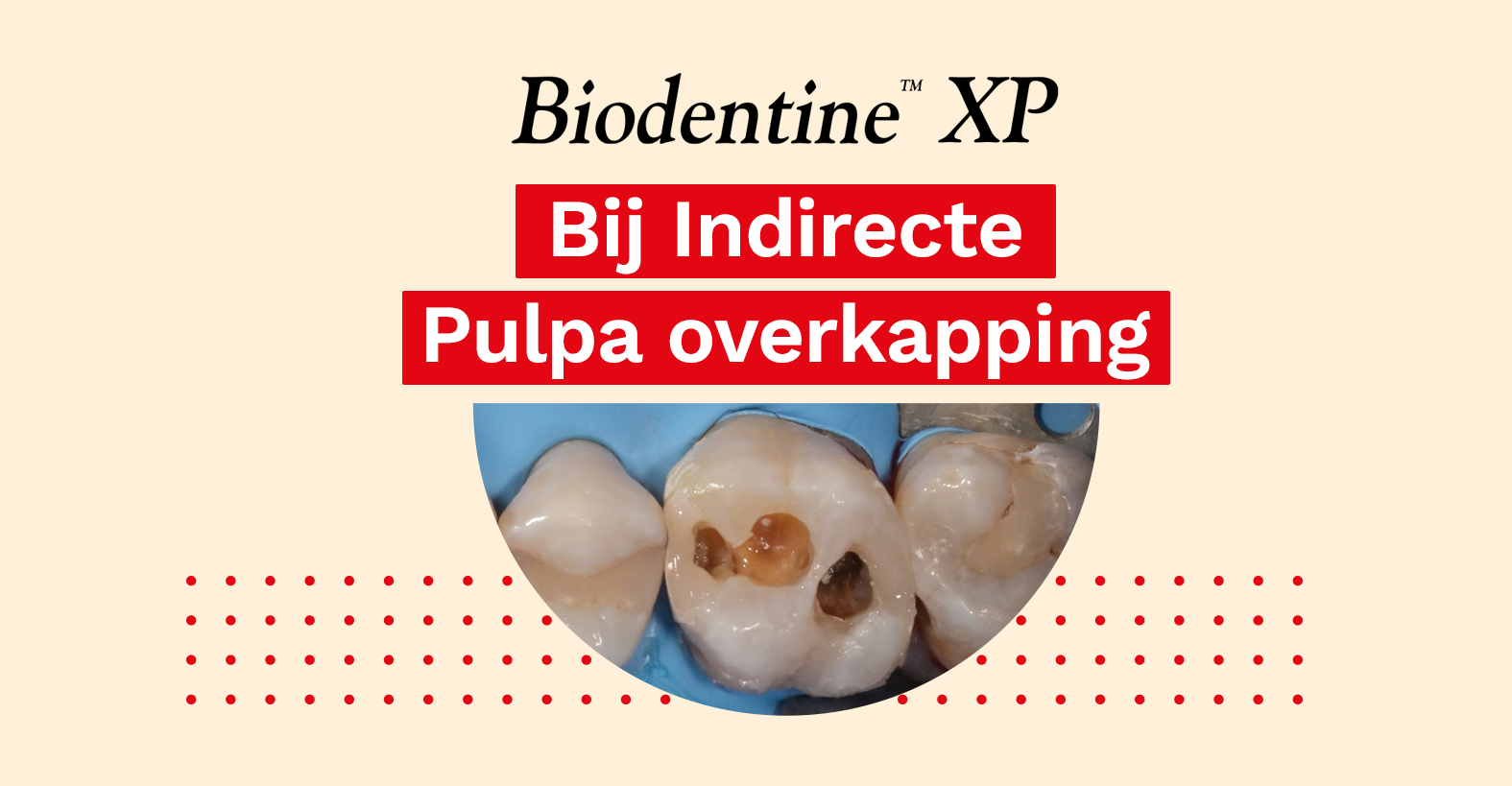 Indirecte pulpa overkapping – Dr Ganowicz - Septodont